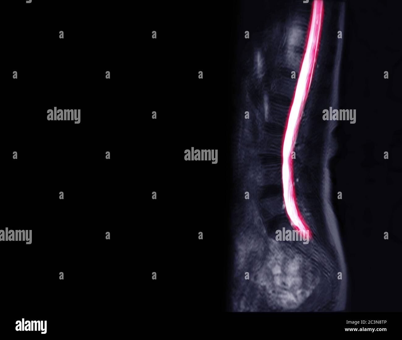MRI L-S spine myelogram technique for diagnosis spinal cord compression ...