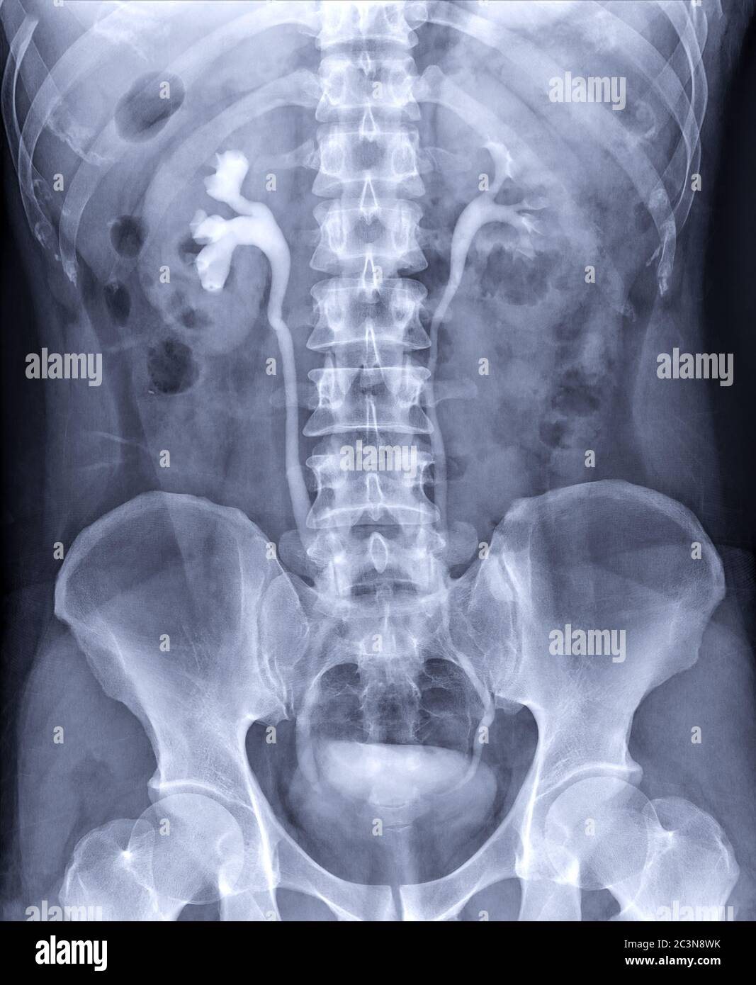 Intravenous pyelogram or I.V.P is an X-ray exam of urinary tract after ...