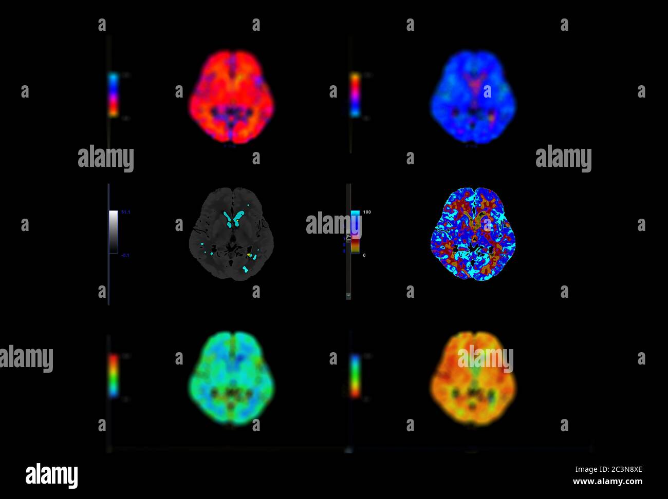 selective focus of CT Brain Perfusion or CT scan image of the brain 3d ...