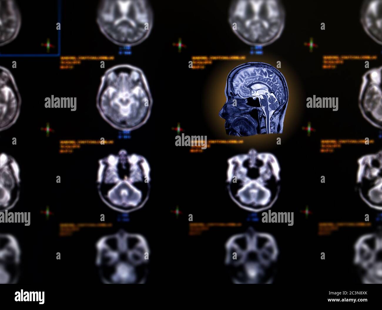 Selective focus of MRI brain sagittal view on blurred mri brain axial ...