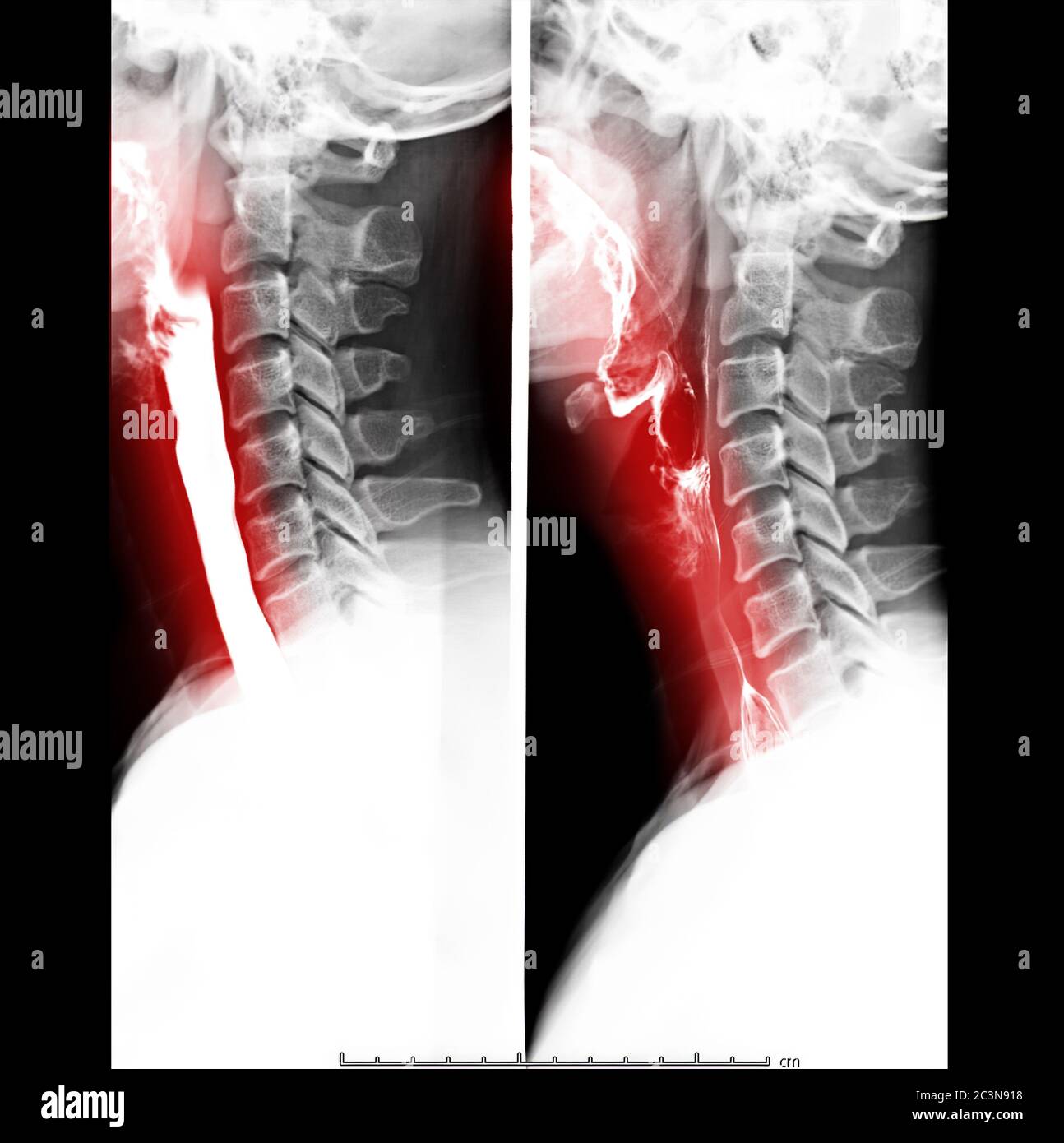 Esophagram or Barium swallow Lateral view showing esophagus for ...