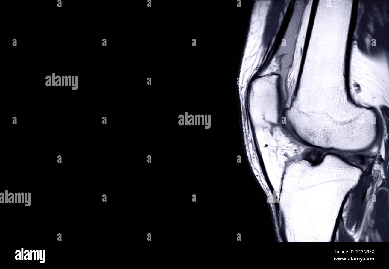 Compare of MRI Knee joint or Magnetic resonance imaging sagital view ...