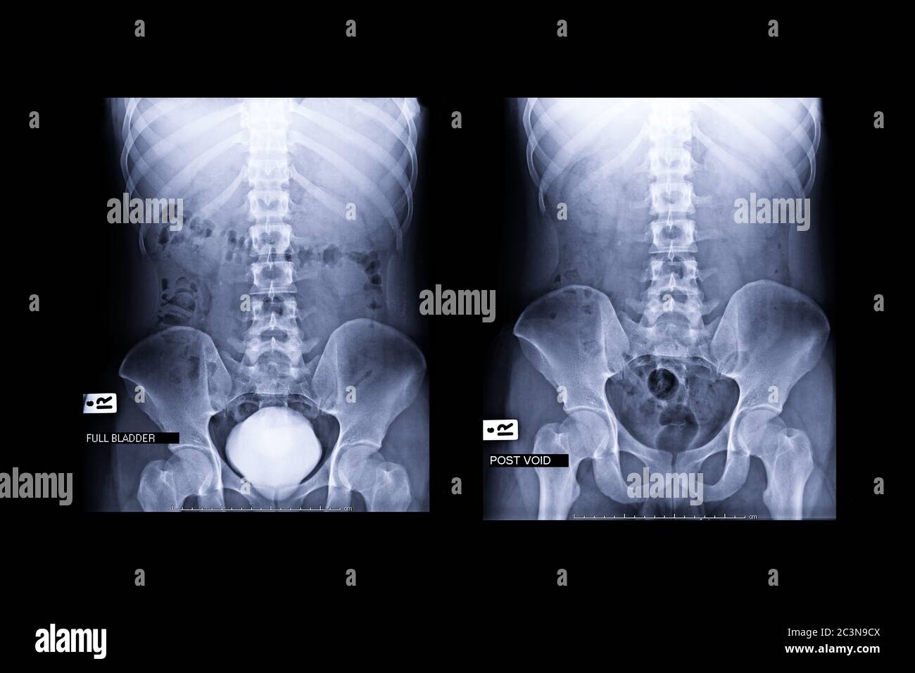 Compare Intravenous pyelogram or I.V.P is an X-ray exam of urinary ...