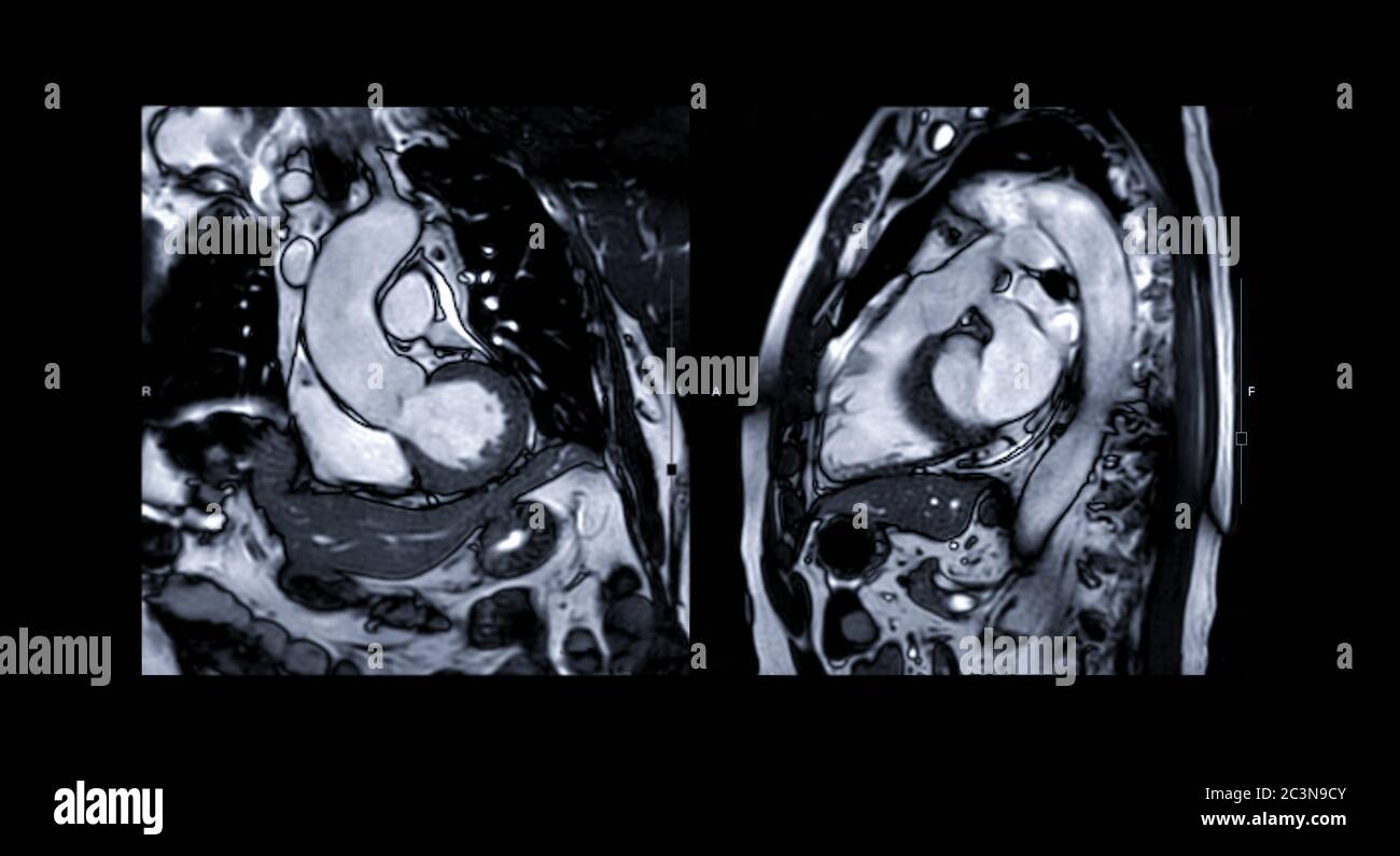 MRI heart or Cardiac MRI ( magnetic resonance imaging ) of heart ...