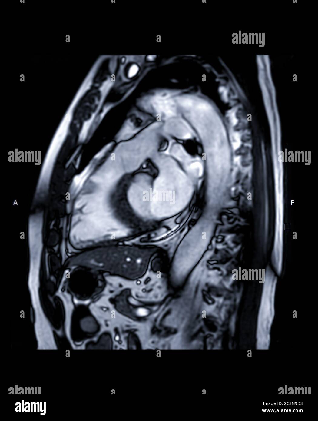 MRI heart or Cardiac MRI ( magnetic resonance imaging ) of heart LVOT ...
