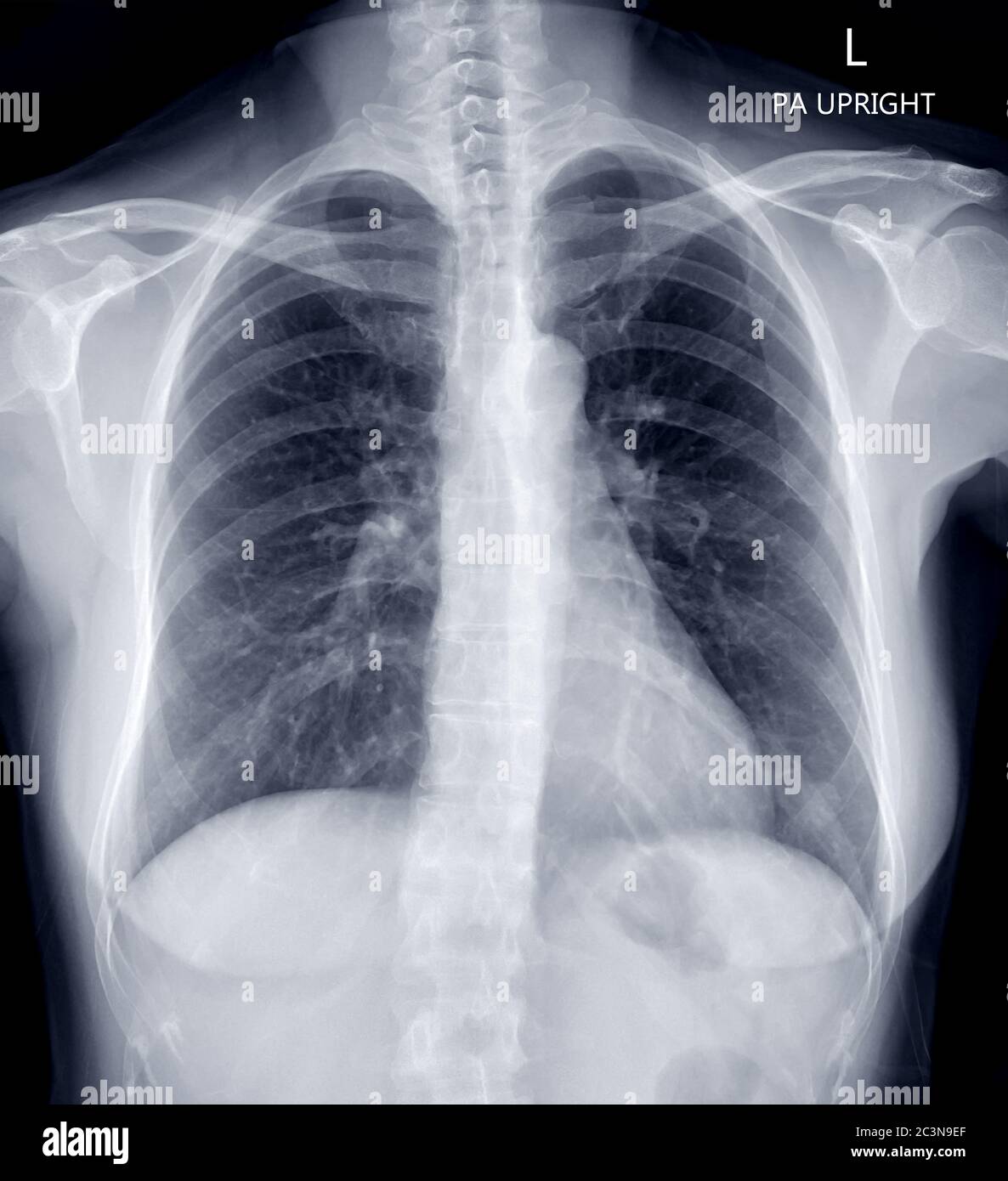 Pulmonary tuberculosis tb chest x ray hi-res stock photography and ...