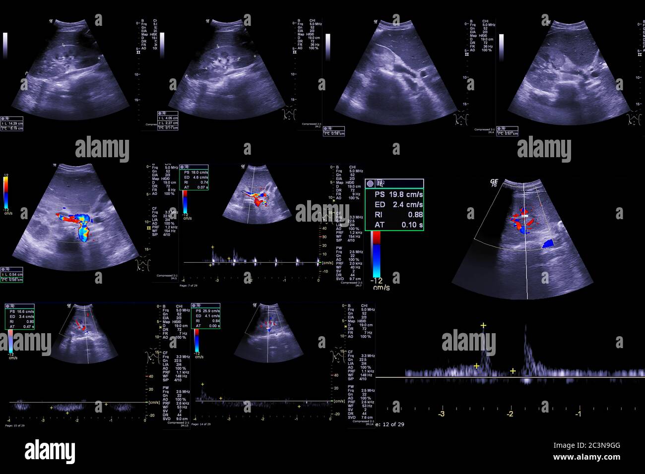 Collection of Ultrasound upper abdomen showing anatomical of ...