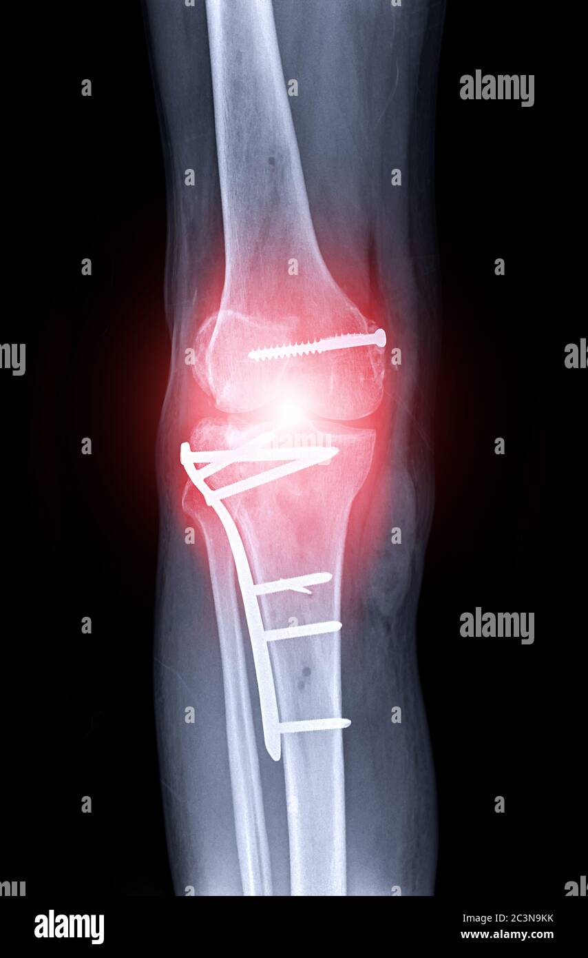 Tibial plateau hi-res stock photography and images - Alamy