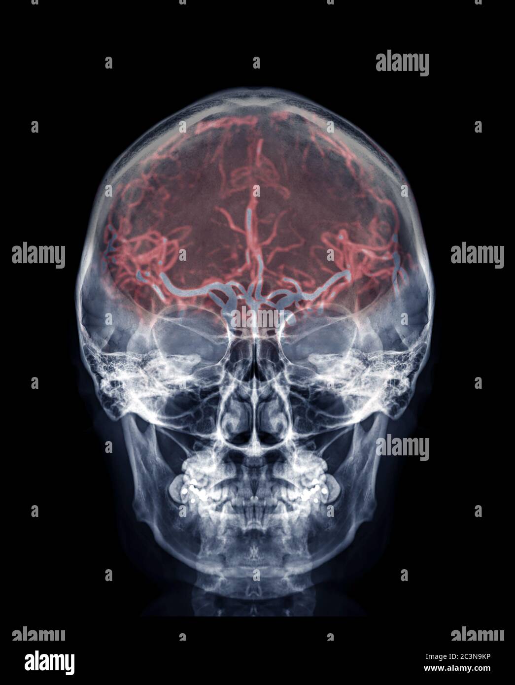 Skull x-ray image of Human skull AP view showing cerebral artery in the ...