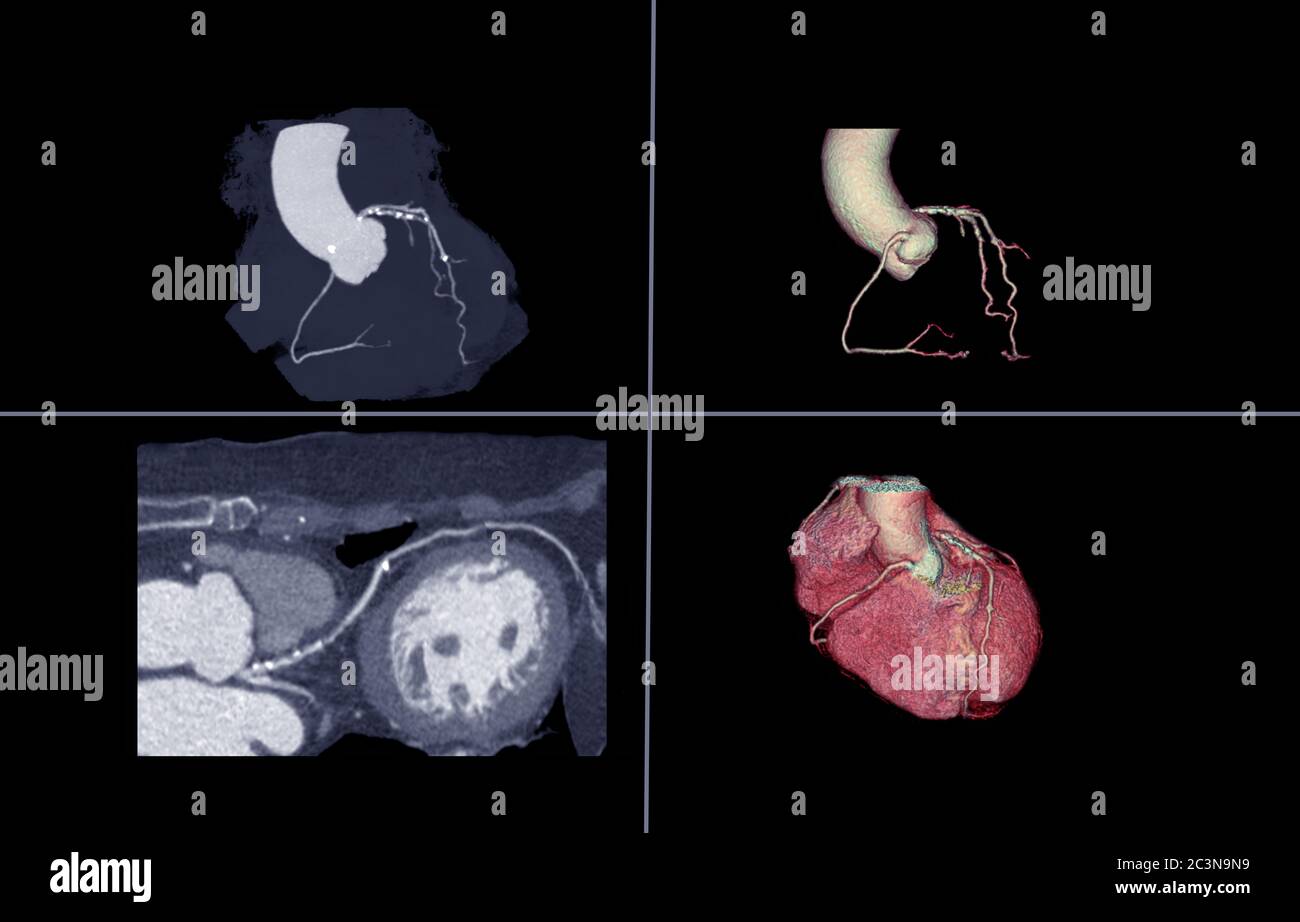 CTA Coronary artery 3D rendering image or coronary tree with Curve MPR ...