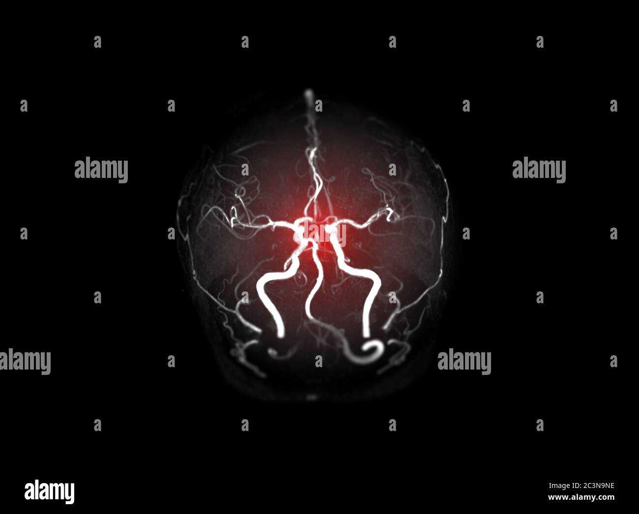 Collection of MRA brain or Magnetic resonance angiography image ( MRA ...