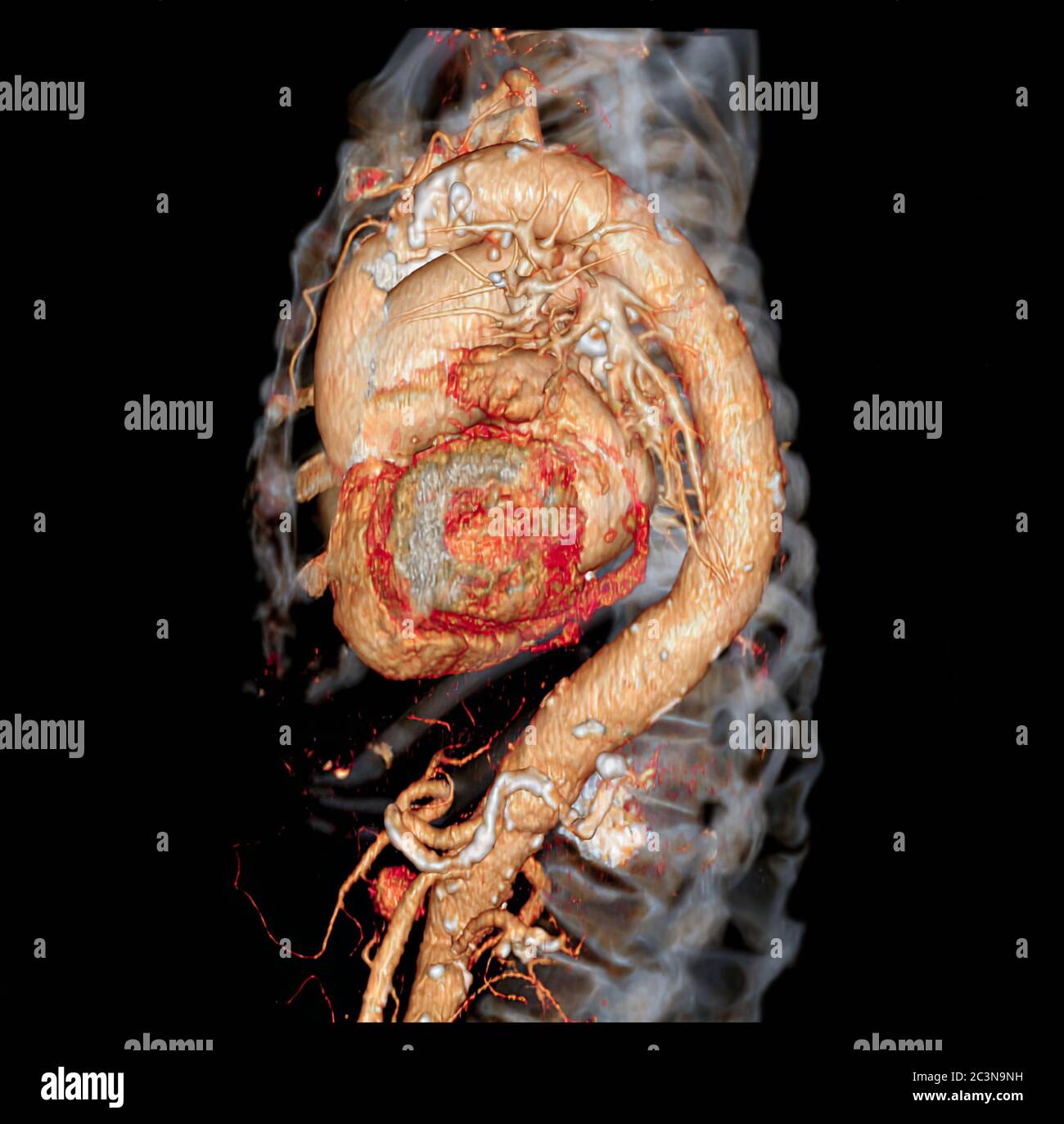 Abdominal aortic aneurysm High Resolution Stock Photography and Images ...