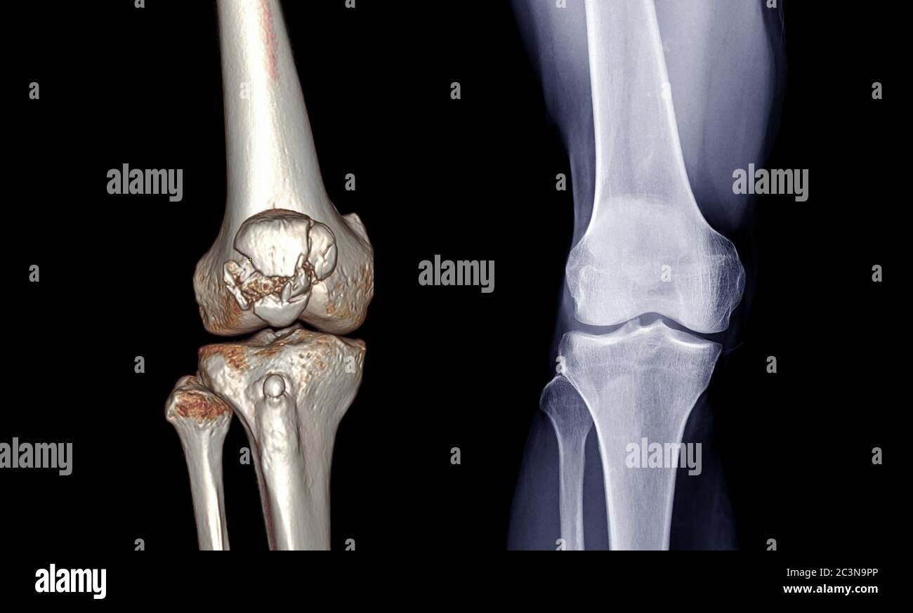 Compare CT knee 3D rendering image and x-ray image AP view isolated on ...