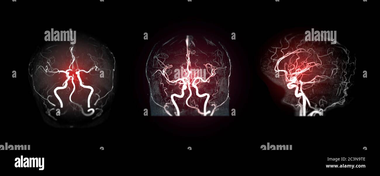 Collection of MRA brain or Magnetic resonance angiography image ( MRA ...