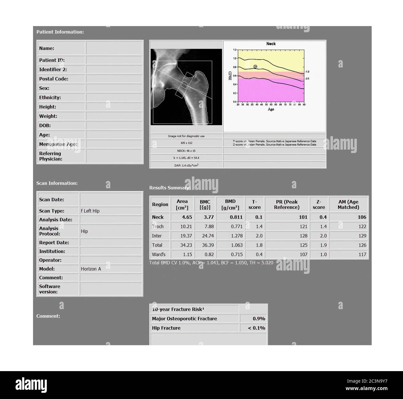 DEXA densitometry report of lumbar hip scan for Osteopenia present ...