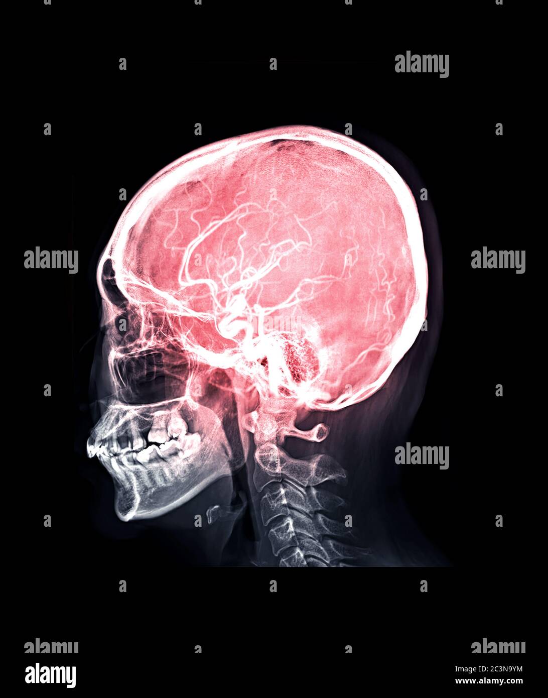 Lateral x ray of skull showing sinuses hi-res stock photography and ...