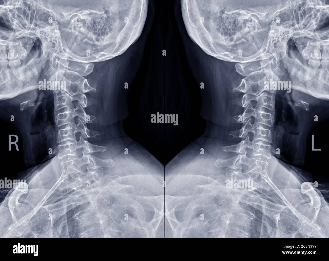 Cervical Spine X Ray Positioning
