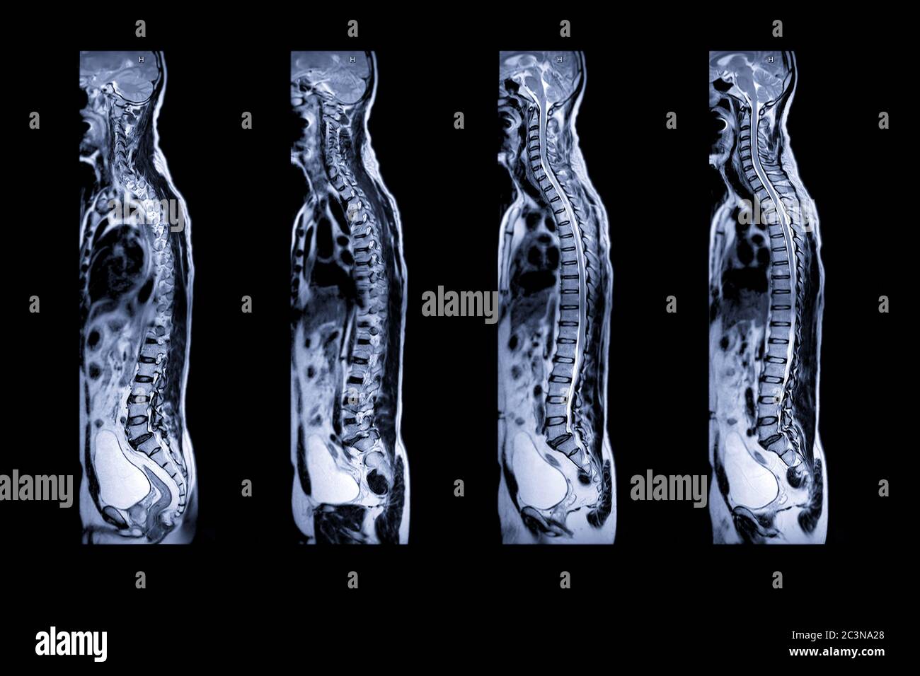Collection of MRI of whole spine T2W sagittal plane for diagnostic ...