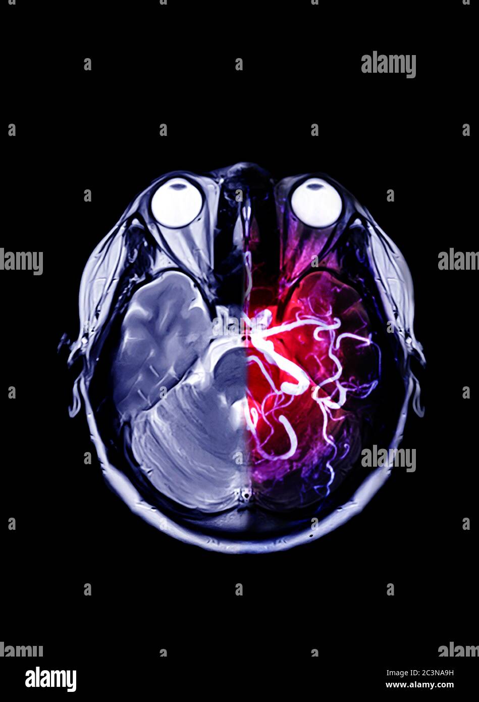Brain anatomy axial hi-res stock photography and images - Alamy