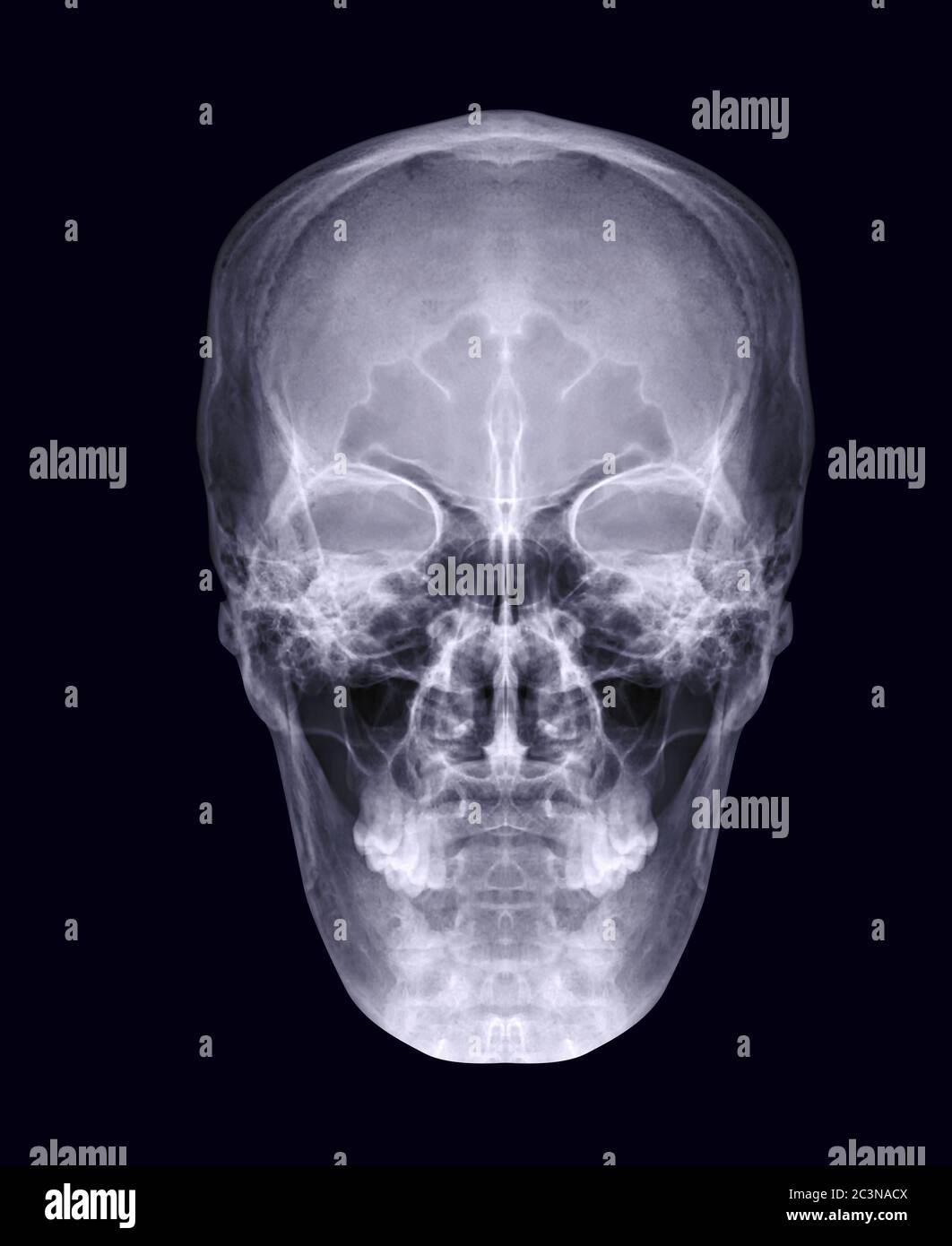 X Ray Human Skull
