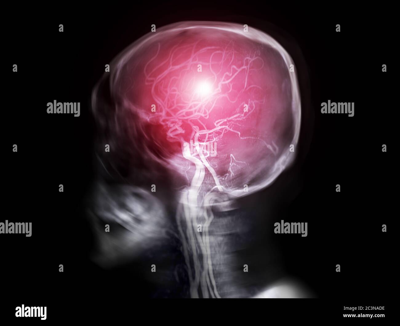 Bone Fusion High Resolution Stock Photography and Images - Alamy