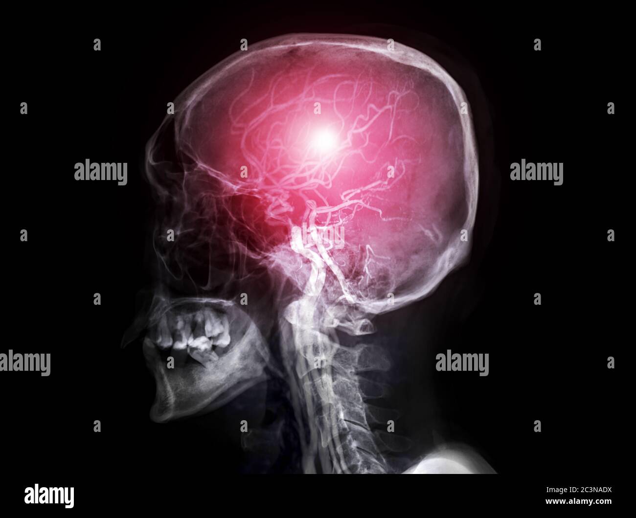 Skull x-ray image of Human skull lateral view fusion with MRA Brain ...