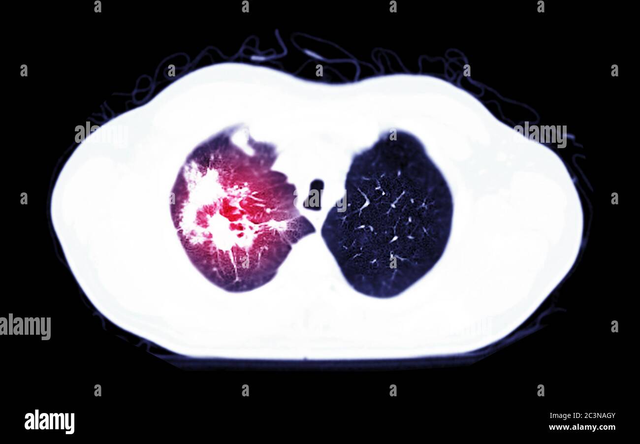 Selective Focus of CT Chest AXIAL MIP view for diagnostic Pulmonary ...