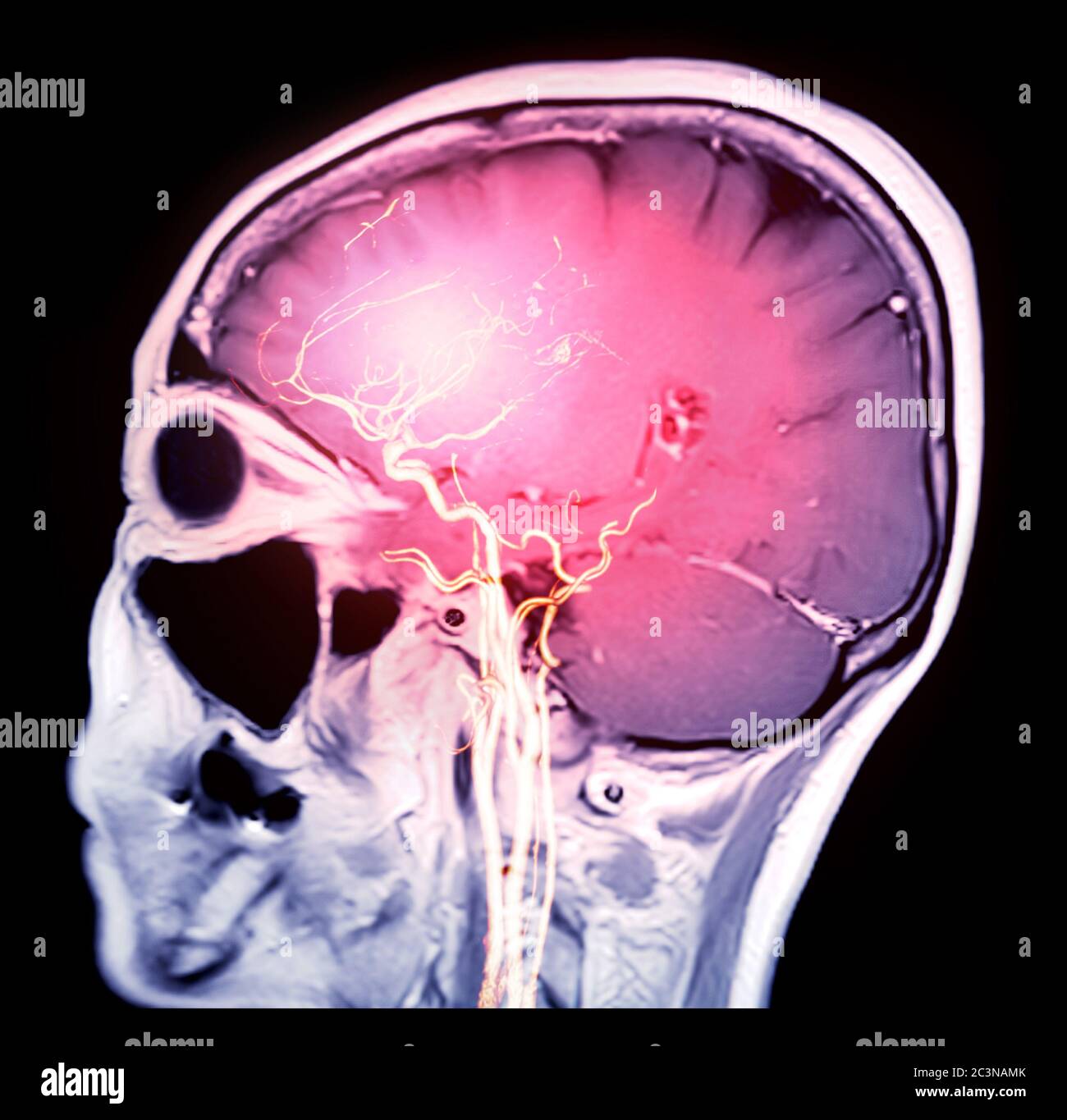 MRI brain T1 sagittal plane with 3D rendering CTA Brain Stock Photo - Alamy