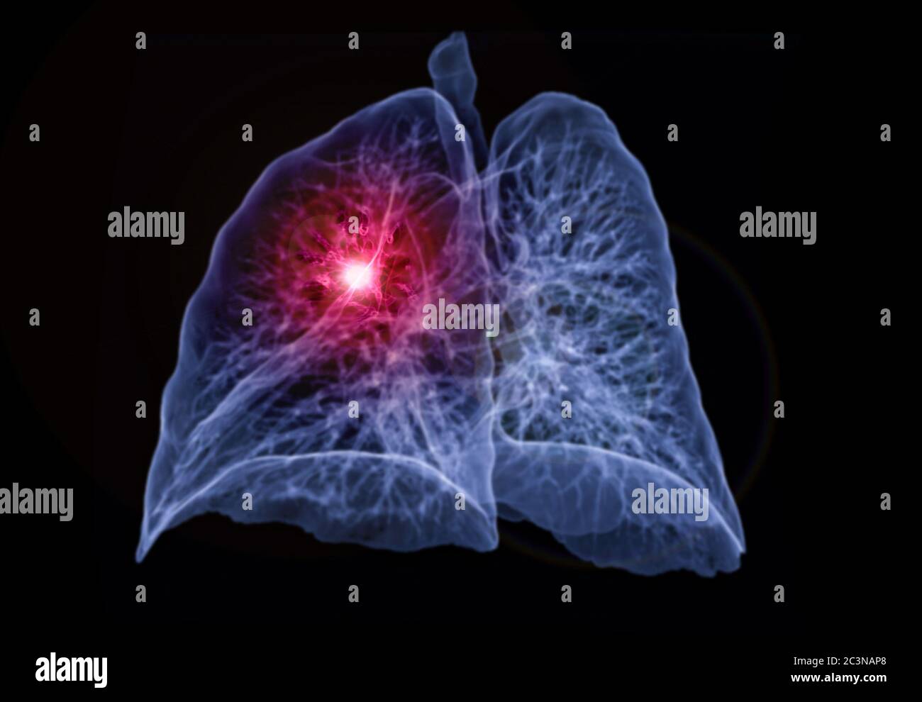 CT Chest or Lung 3D rendering image Right oblique view showing lesion ...