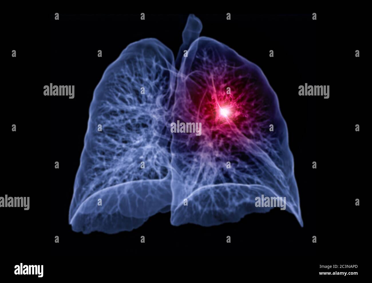 CT Chest or Lung 3D rendering image left oblique view showing lesion ...
