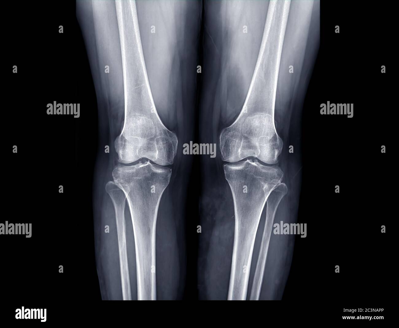 x-ray image of both knee AP view for detect Osteoarthritis Knee or OA ... x-ray image of both knee AP view for detect Osteoarthritis Knee or OA ...