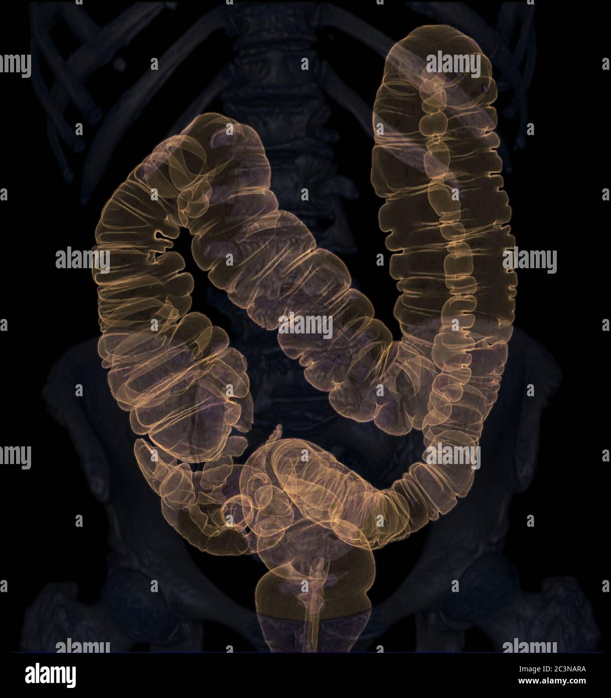 CT colonography 3D Rendering image showing colon for screening ...