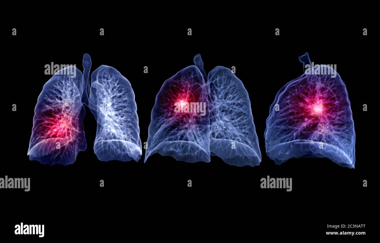 Collection of CT Chest or Lung 3D rendering image showing lesion for ...