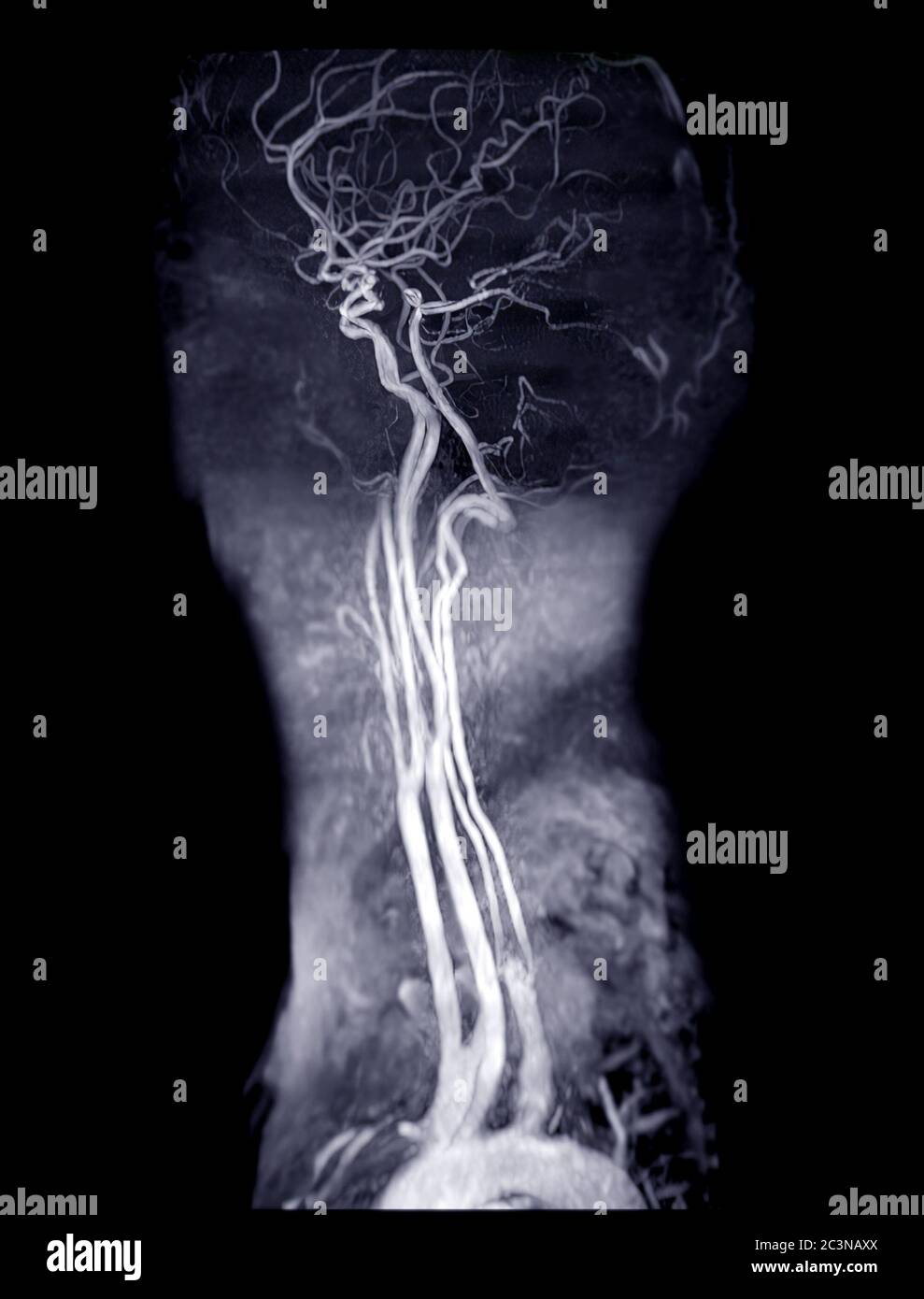 MRA Brain and NECK or Magnetic resonance angiography ( MRA ) lateral ...