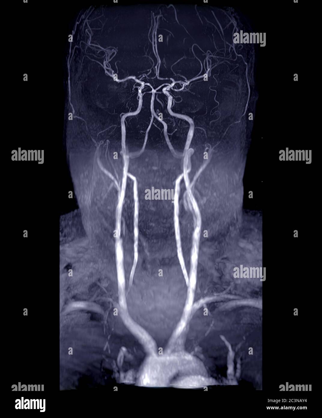 MRA Brain and neck or Magnetic resonance angiography ( MRA ) of ... MRA Brain and neck or Magnetic resonance angiography ( MRA ) of ...