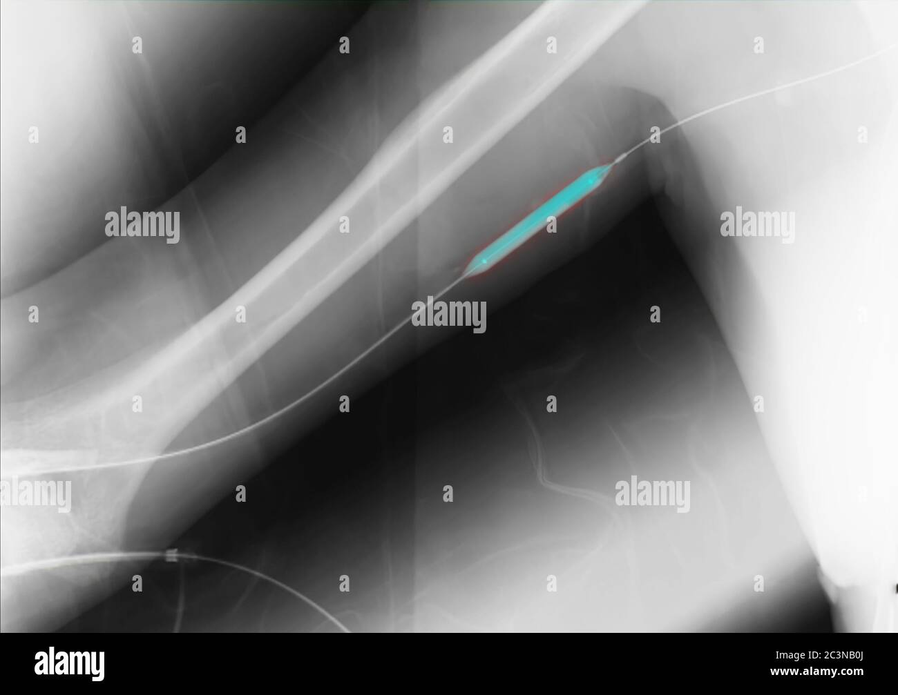 Angioplasty, balloon angioplasty and percutaneous transluminal ...