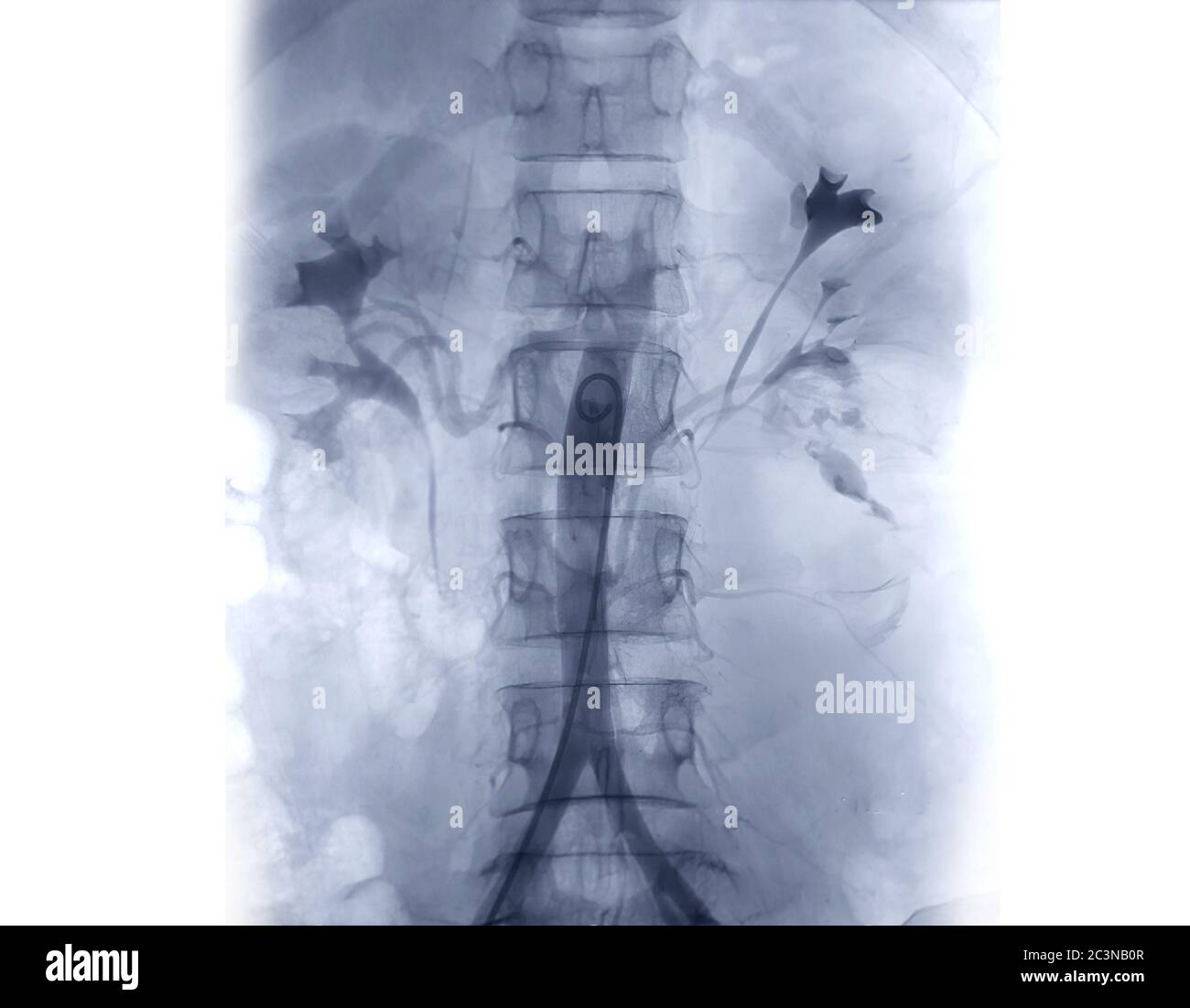 Selective Angiography for Renal Artery Diseases Stock Photo - Alamy