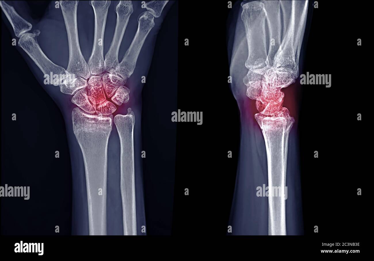 X-ray image of Right wrist joint Ap and Lateral view for diagnosis ...