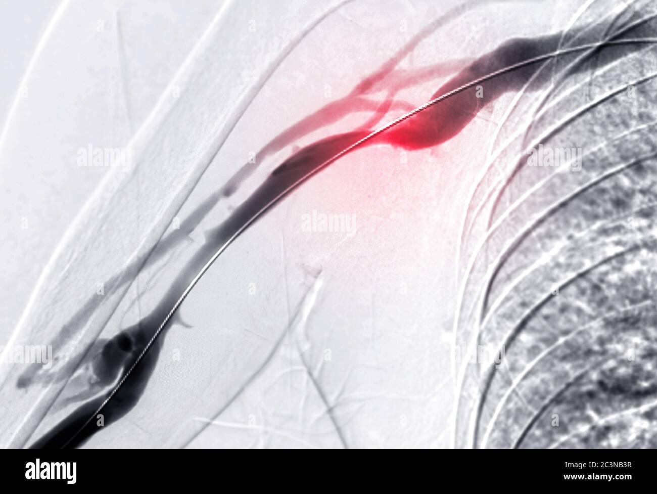 Angioplasty, balloon angioplasty and percutaneous transluminal ...