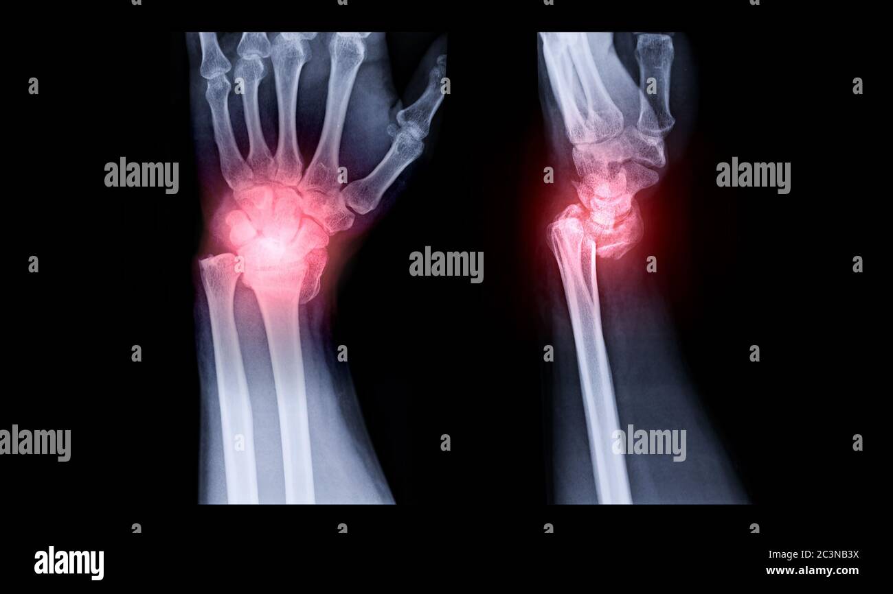 X-ray image of Left wrist joint AP and Lateral view for showing ...