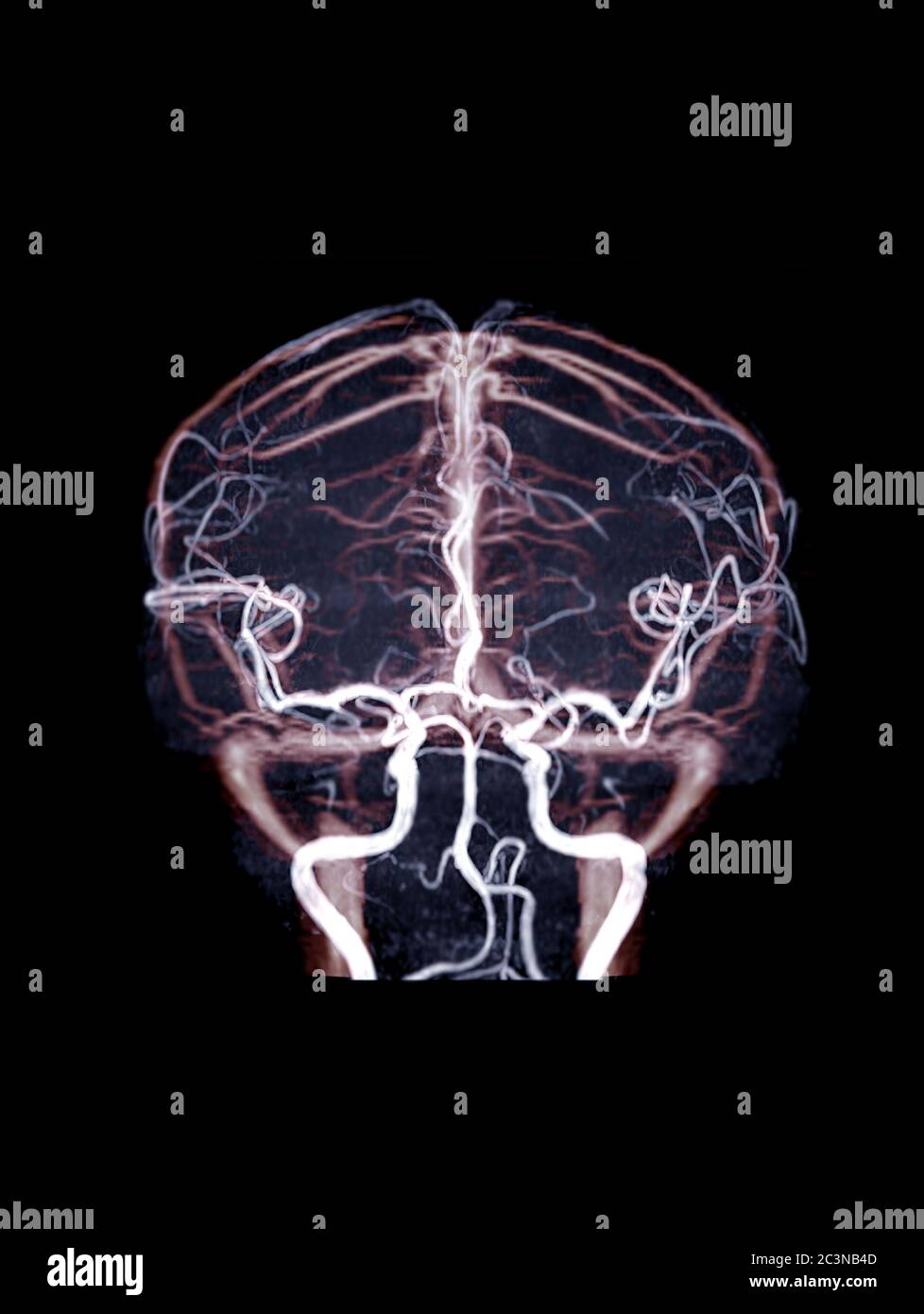 Mrv angiogram hi-res stock photography and images - Alamy