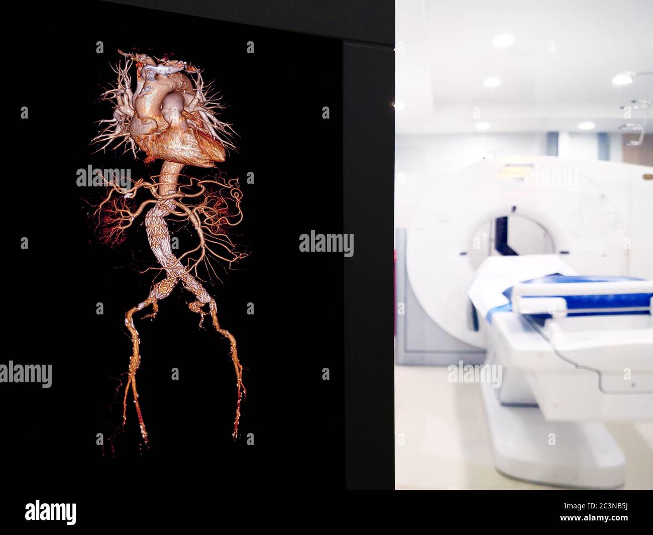 CTA abdominal aorta 3D rendering image with stent graft on transparent ...