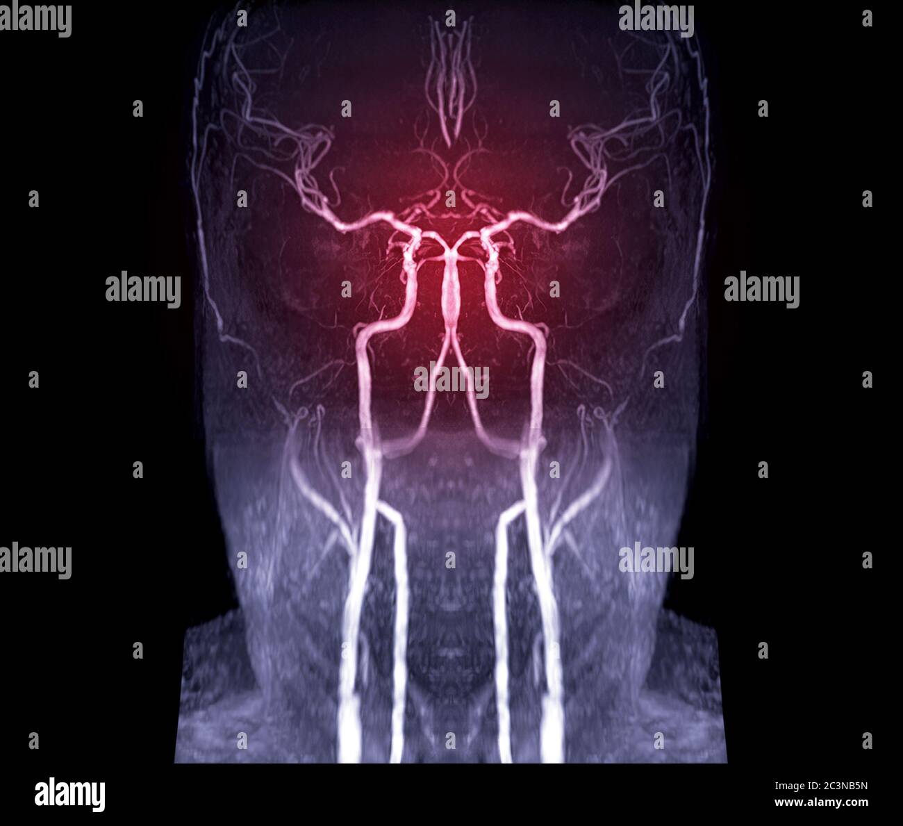 Basilar Artery High Resolution Stock Photography and Images - Alamy