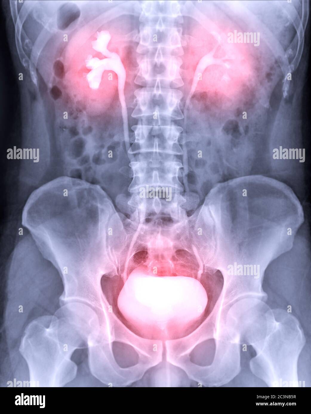 Intravenous pyelogram or I.V.P is an X-ray exam of urinary tract after ...