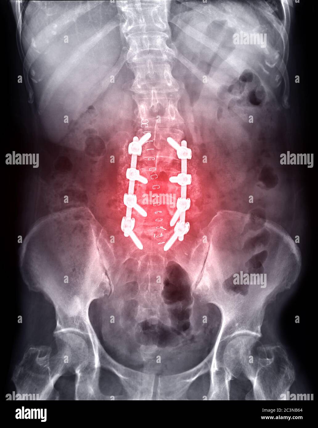 X-ray image of lambosacral spine or L-S spine AP Post operative Fix ...