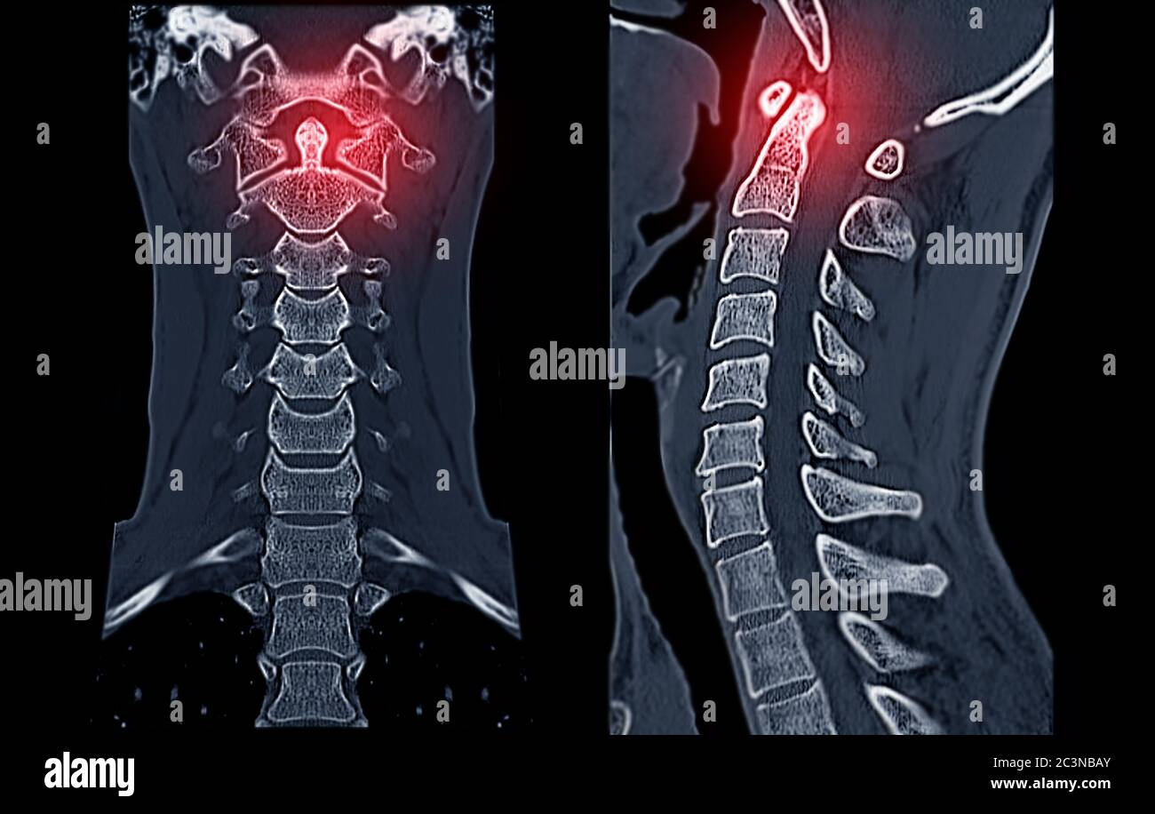 Arthritis in the cervical spine hi-res stock photography and images - Alamy