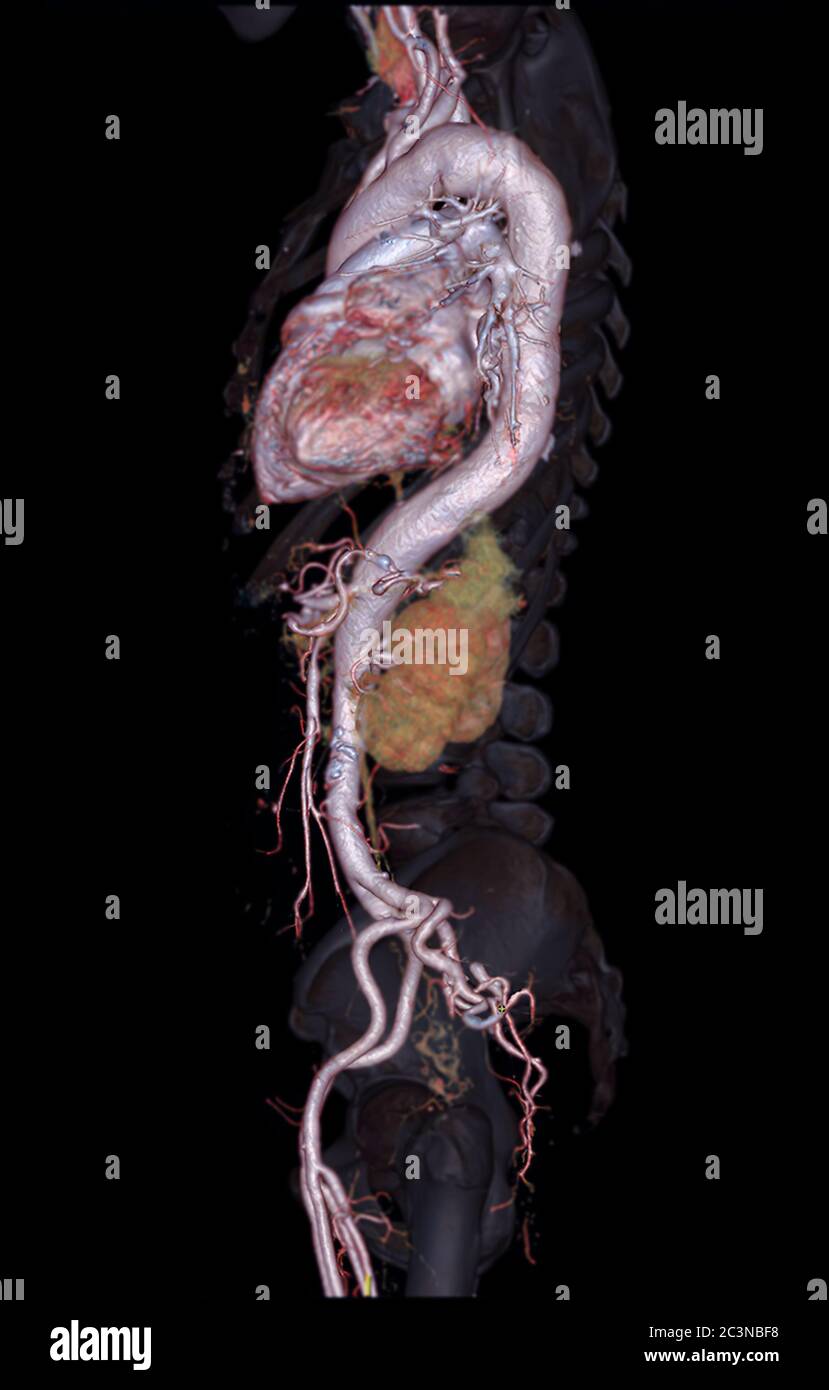 CTA abdominal aorta 3D rendering image on transparent skeletal Stock ...