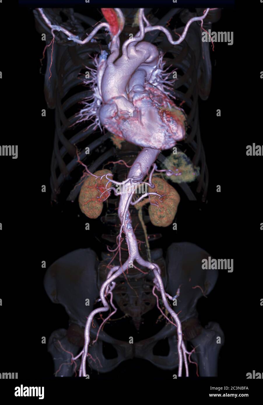 Abdominal aorta 3d ct scan hi-res stock photography and images - Alamy