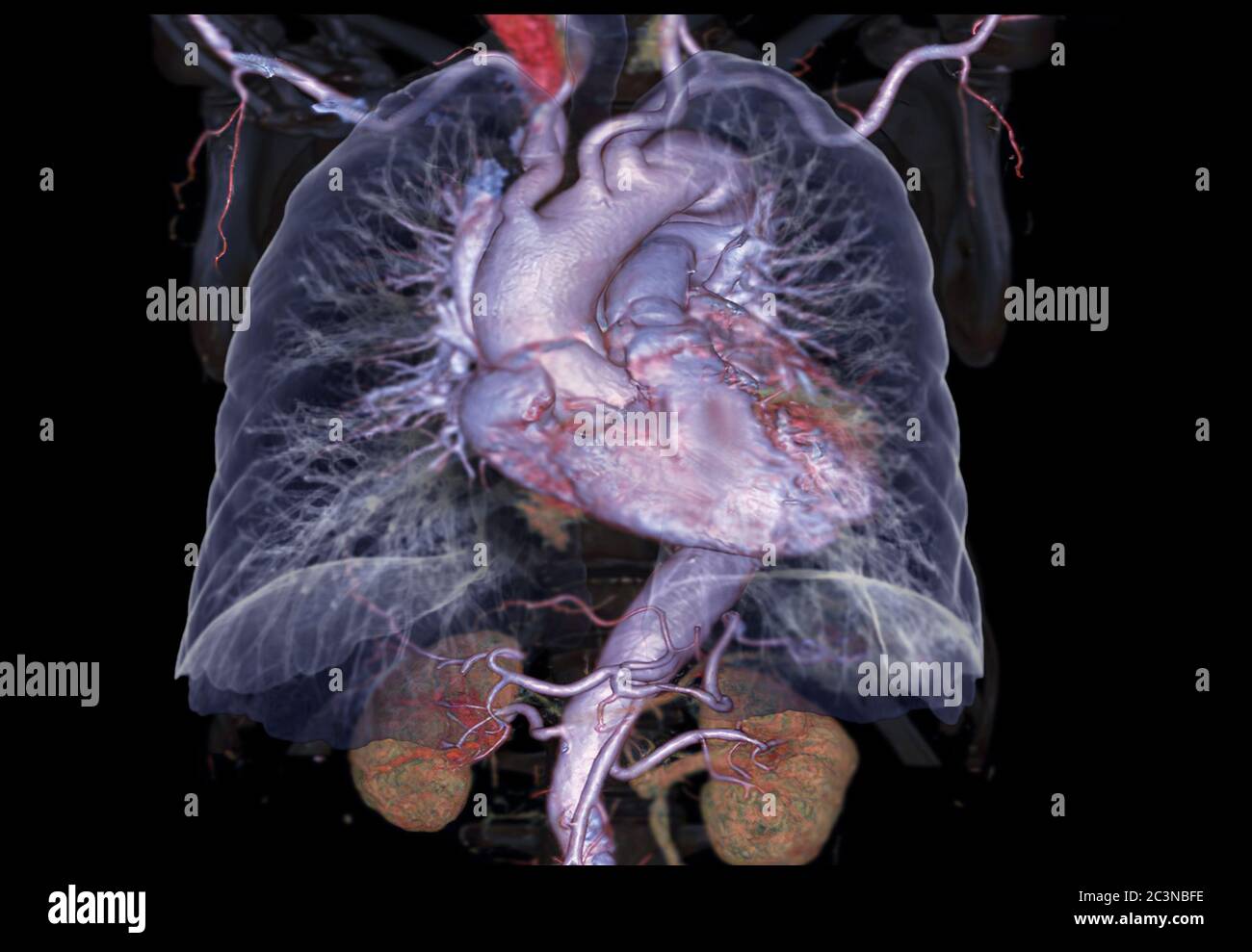 CTA Chest with Lung 3D rendering image showing heart ,lung amd bone ...