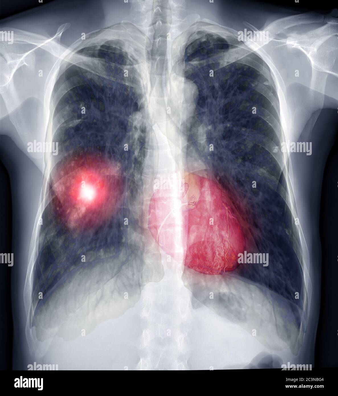 Chest x-ray fusion image with CT Chest or Lung 3D rendering image with ... Chest x-ray fusion image with CT Chest or Lung 3D rendering image with ...